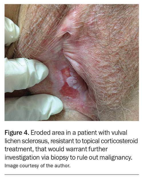 Vulval lichen sclerosus: not uncommon, serious and often missed | Medicine Today